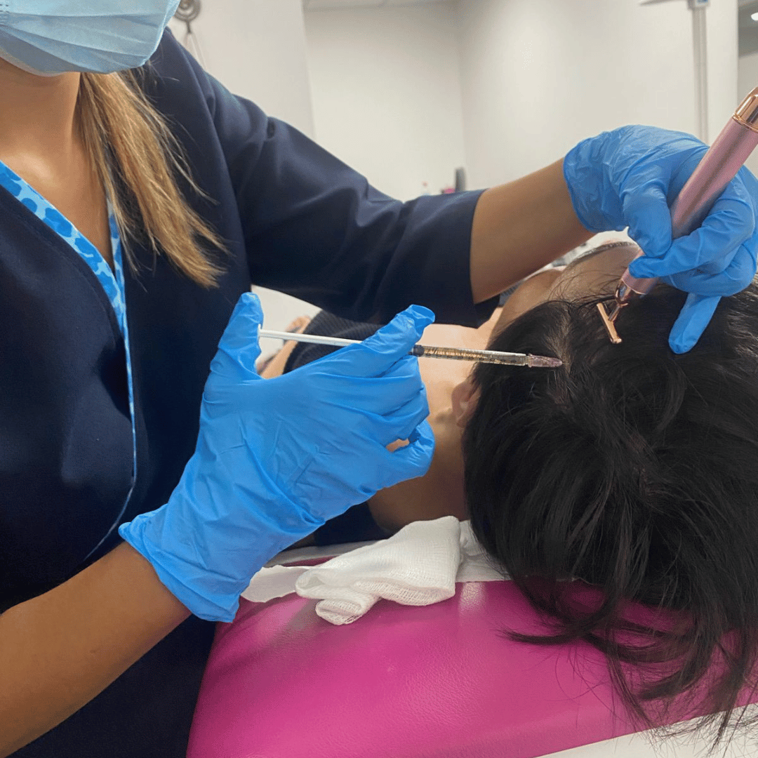 Plasma rico en plaquetas Capilar con Microneedling